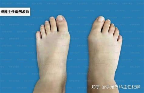 拇外翻才做完7天已经上班啦 知乎