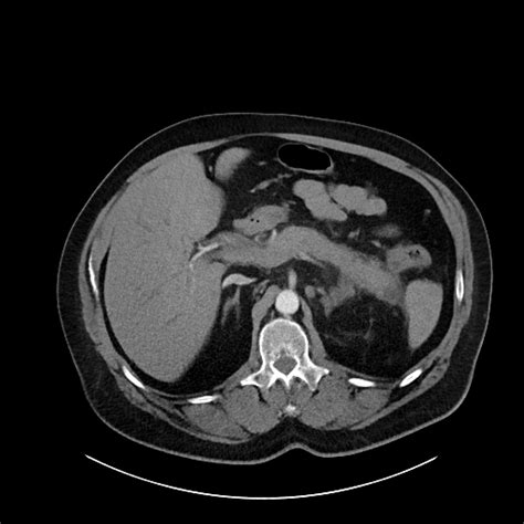 File Igg4 Related Autoimmune Cholangitis Pancreatitis And Pseudotumor Radiopaedia 99511