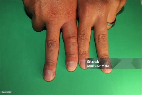 Hinchazón Del Dedo Índice Derecho Por Una Picadura De Abeja La