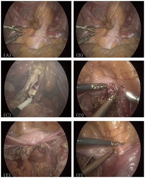 Frontiers Case Report Full Thickness Prolapse Of A Neovagina Created