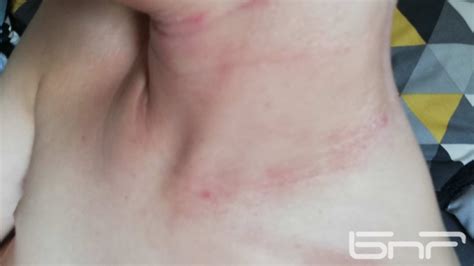 Безплатни прегледи за деца с тежък атопичен дерматит Записвания до 10