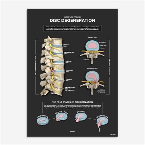 Intervertebral Disc Degeneration Poster Kirografiks