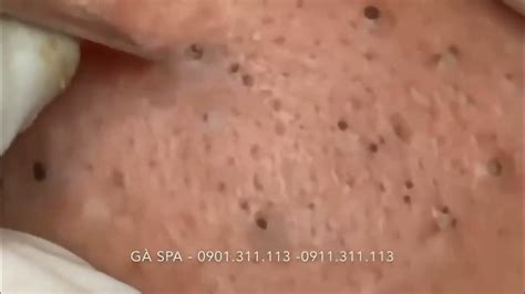 ШОК Удаление и выдавливание чёрных точек Чистка лица Прыщи выдавливание Удаление прыщей