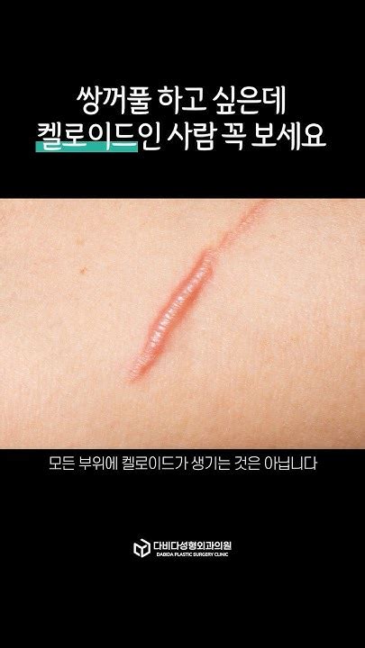 켈로이드 피부 가지고 있다면 성형은 Youtube