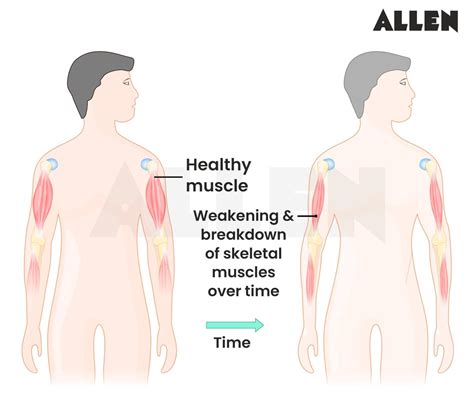 Muscular Dystrophy Causes Signs And Faqs