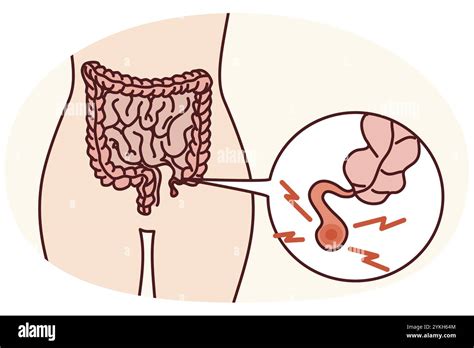 Closeup Of Human Body With Inflamed Appendix Person Suffer From