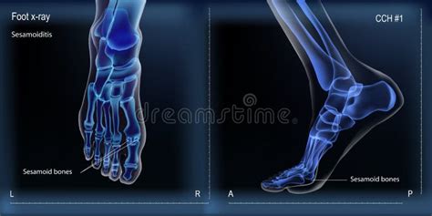 Medial View X Ray Of Bones The Of Foot With Sesamoid Stock Vector