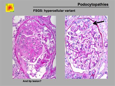 Focal Segmental Glomerulosclerosis Clinical Course And Outcome Of