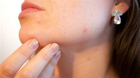 How Long Does It Take To Get Rid Of Demodex Mites Ungex Demodex