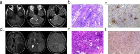 Mri Based Machine Learning Models Predict The Malignant Biological Behavior Of Meningioma Pmc