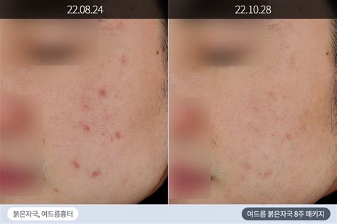 모공·흉터 세종스노우의원