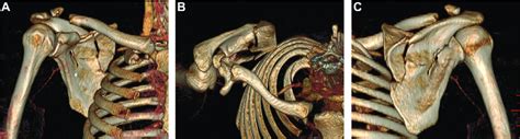 3d Ct Reconstructions Further Demonstrating The Scapula Fracture Download Scientific Diagram