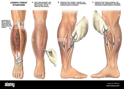 Left Leg Fasciotomy