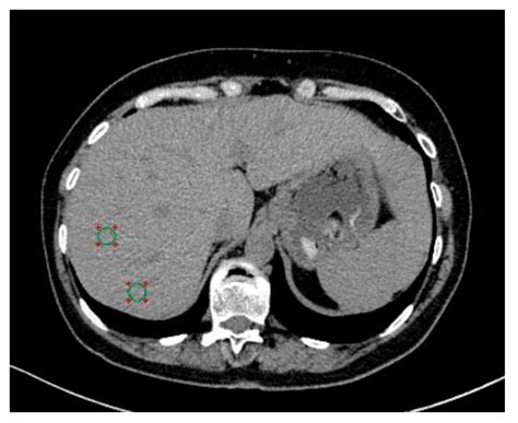 Cirrhosis Ct Scan