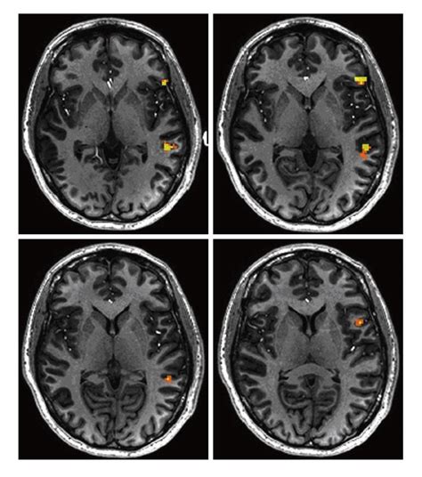Cerebrovascular Reactivity Mapping For Brain Tumor Presurgical Planning