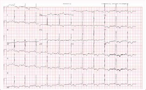 EKG Of Our Patient Showing Diffuse Precordial T Wave Inversion And LV Download Scientific