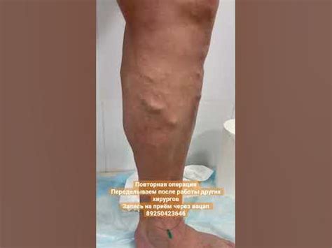 Рецидив варикоза после ЭВЛК (лазерной операции). Как лечить варикоз ...