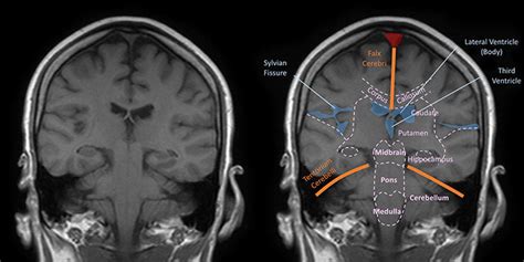 Diagram Of Coronal Mri Brain T1 Quizlet Diagram Of Coronal Mri Brain T1 Quizlet