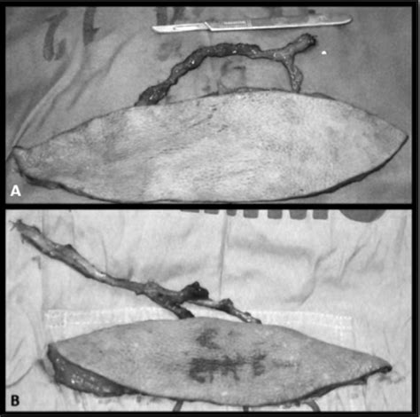 Harvested Alt Flaps A Right Alt Flap Which Measured 8 X 22cm B Left