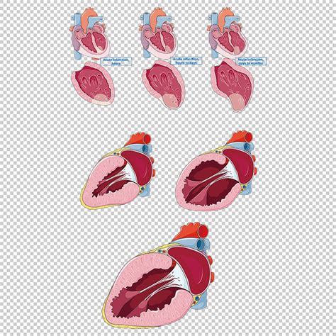 Left Ventricular Remodeling Following Myocardial Infarction Vector
