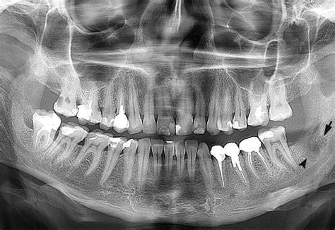 Alveolar Osteitis Radiograph