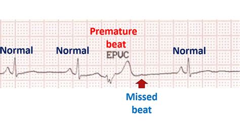 Missing Pulse Beats At George Farrow Blog