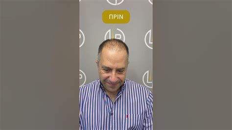 Mεταμόσχευση μαλλιών από τον Λευτέρη Παπανικολάου 10 χρόνια νεότερος ο αδερφός του Lp Clinic