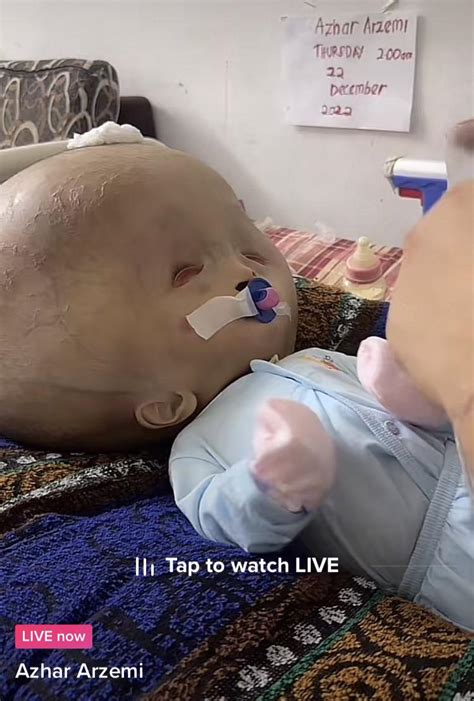 A Rare Survivor Of Harlequin Type Ichthyosis A Terrifying Genetic Disorder That Causes