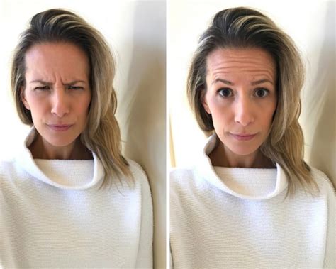 Botox Advice Regrets And Before After My Kind Of Sweet
