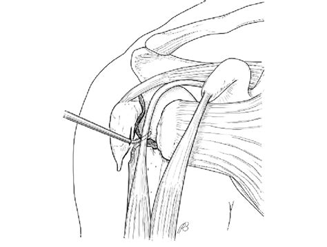 4 A Blunt Tipped Elevator Or Small Bone Tamp Is Placed Through The Download Scientific Diagram