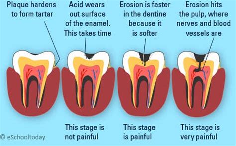 What Causes Cavities And How To Spot Tooth Decay