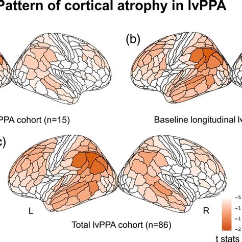 Cross‐sectional Pattern Of Cortical Atrophy In Logopenic Variant Of