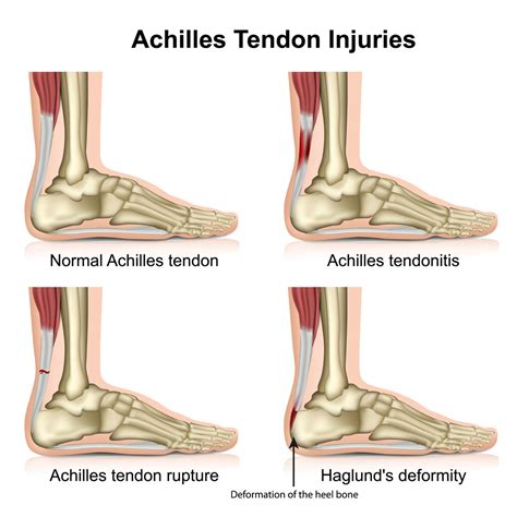 Achilles Tendon Injuries Tendonitis Tendinosis Tear Rupture