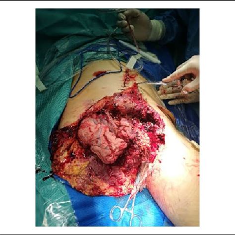 A 32 Year Old Female With A Devastating Open Pelvic Fracture Tile C Download Scientific