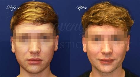 Buccal Fat Pad Removal Before And After Gallery Laacib