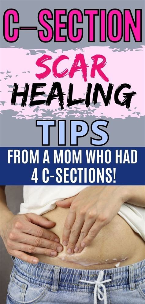 C Section Scar Recovery Artofit
