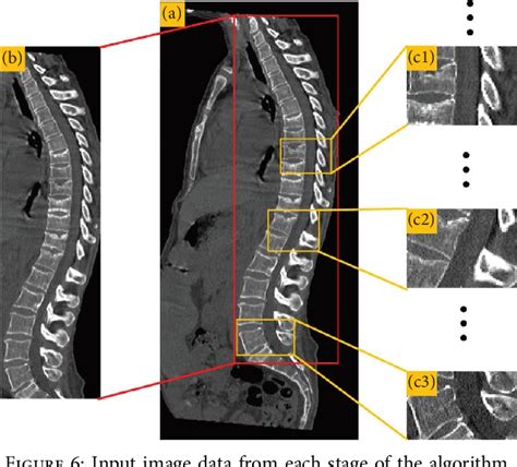Figure From A Spine Segmentation Method Under An Arbitrary Field Of View Based On D Swin