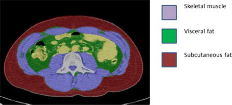 Subcutaneous Fat Visceral Fat And Skeletal Muscle As Depicted On An