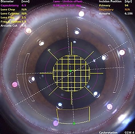 Comparing Postoperative Astigmatism Following Toric Iol Implantation Vs Femtosecond Laser