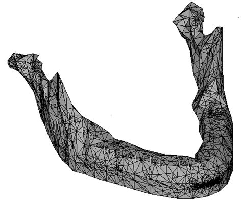 3 Dimensional Finite Element Fractured Mandibular Model Fixed With A
