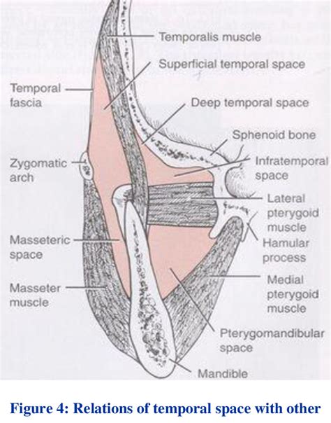 Figure 1 From A Rare Case Of Temporal And Infratemporal Space Abscess Secondary To Masseteric