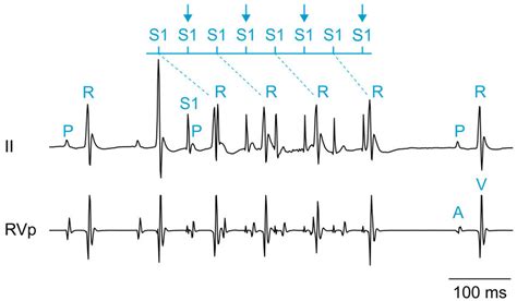21 Conduction Stimulation Protocol To Determine The 21 Cycle Length Download Scientific