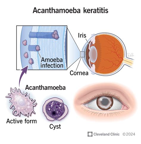Bacterial Keratitis Symptoms Common Eye Infections Symptoms Eye