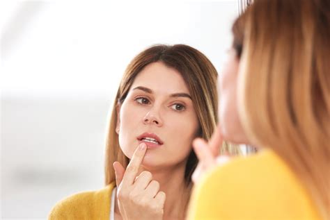 What Causes Cold Sores And How Should They Be Treated Parkview Health