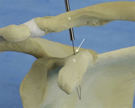 The Passing Suture For The No 5 Interconnecting Suture Is Taken