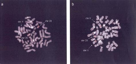 Figure 1 From Disruption Of The Iqsec2 Transcript In A Female With X Autosome Translocation T X