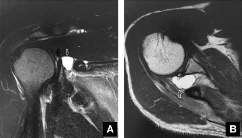 Figure 1 From Arthroscopic Decompression Of Spinoglenoid Notch Cyst And
