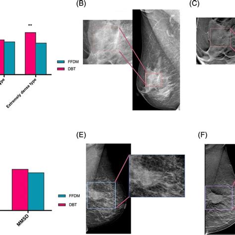 Diagnostic Accuracy Of Digital Breast Tomosynthesis Dbt And Download Scientific Diagram