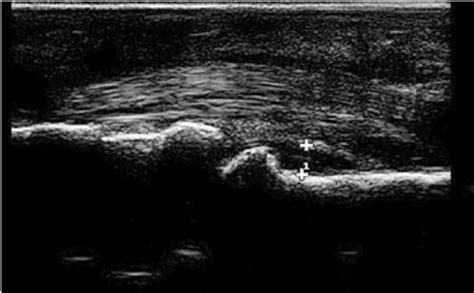 Longitudinal Scan Over The Palmar Aspect Of The Ii Mcp Joint Grey Download Scientific Diagram