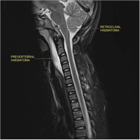 Mri Sagittal View Revealing Retroclival And Prevertebral Hematoma Download Scientific Diagram